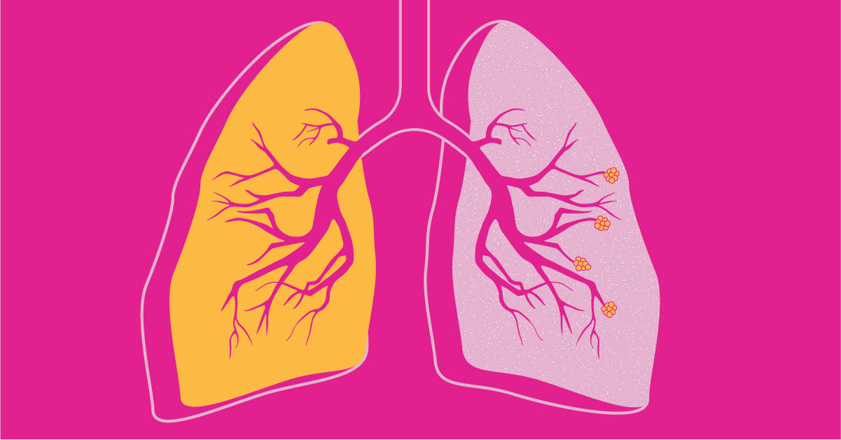 Sëmundja Pulmonare Obstruktive Kronike (COPD) - Informacion